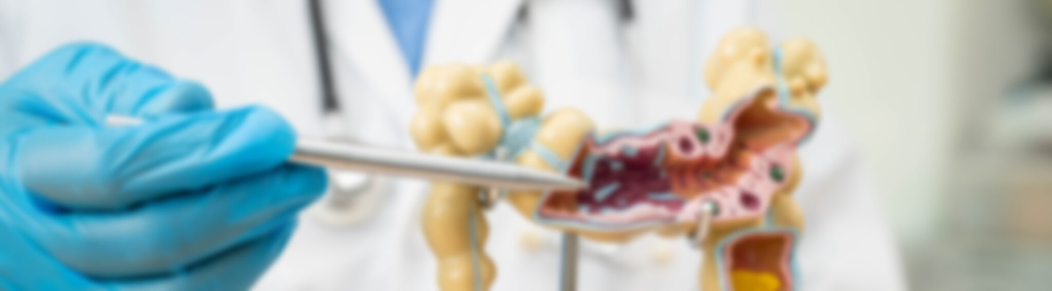 All About Polyps - Colon Cancer Coalition